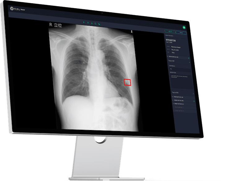 EIRL(エイル) | AI画像診断支援技術 | エルピクセル株式会社 - EIRL（エイル）は、CT, MRI, 病理画像などの医療画像を中心に多様な医療ビックデータを活用し、独自の人工知能 ...
